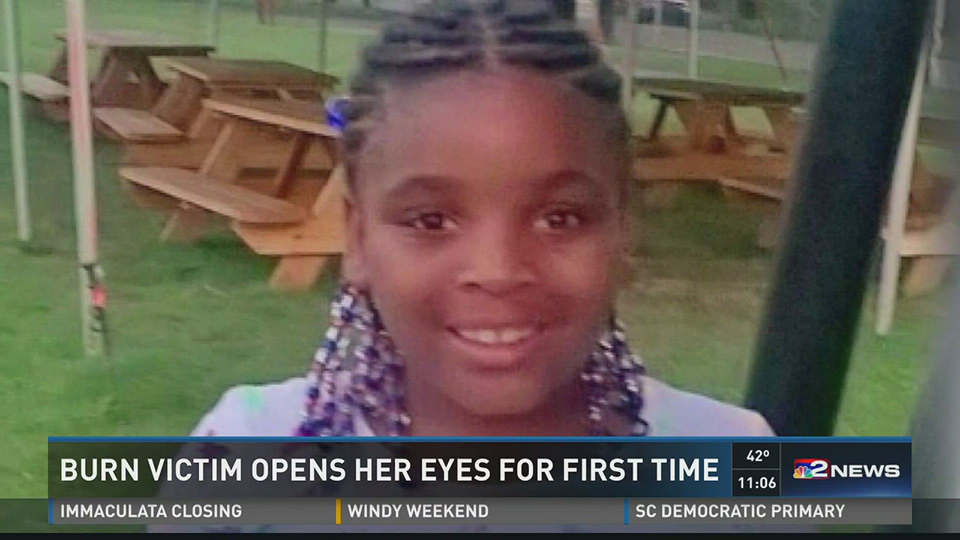 Humber Ave. burn victim opens her eyes for first time | wgrz.com