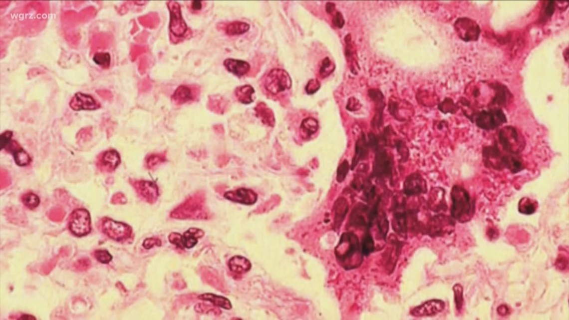 Case of measles in Erie County | wgrz.com